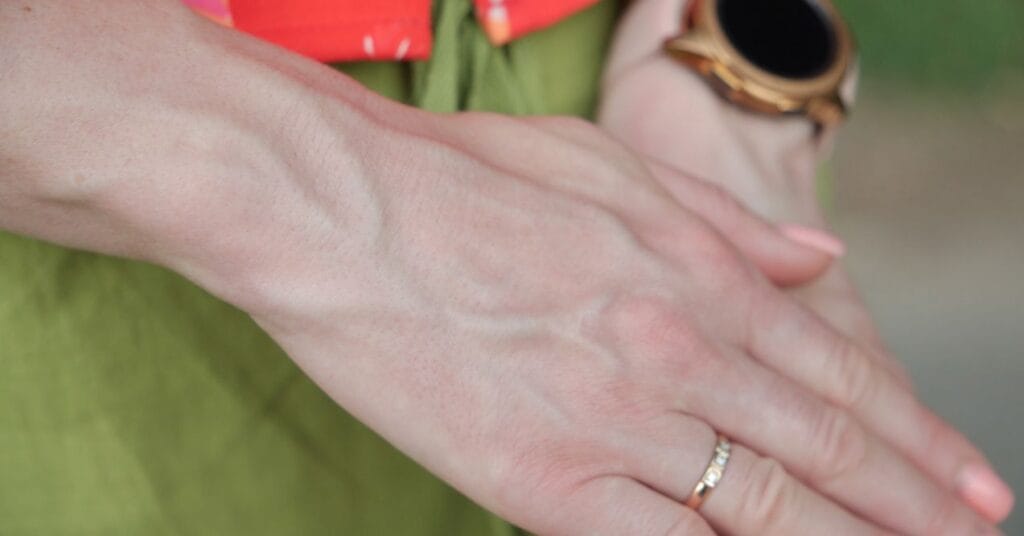 What is a Blown Vein? - Vein Collapse | Nation Health MD