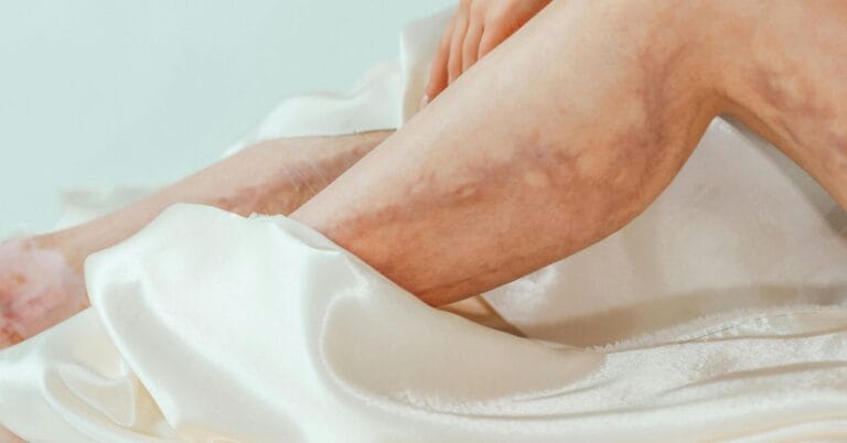 What is a Blown Vein? - Vein Collapse | Nation Health MD
